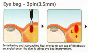 Non-Surgical Eye Bag Removal | Lim Clinic Aesthetic Clinic