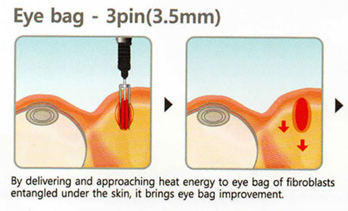 Non-Surgical Eye Bag Removal | Lim Clinic Aesthetic Clinic