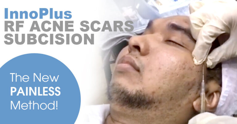 Subcision for Acne Scars in Singapore | Effective Acne Scar Treatment
